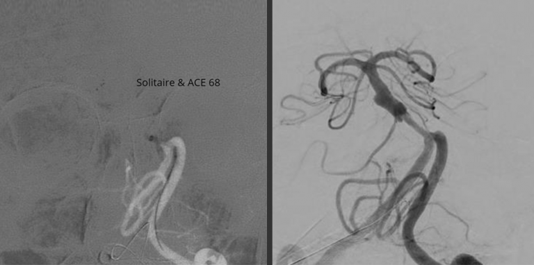 Basilar Artery Thrombosis Jaipurneuro