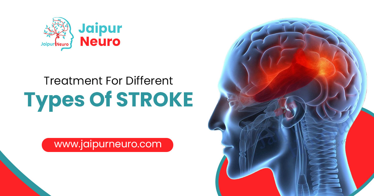 Treatment For Different Types OF STROKE - Jaipur Neuro